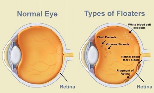 Ever Wondered What Those Strange Floating Transparent Worms In Our Eyes ...