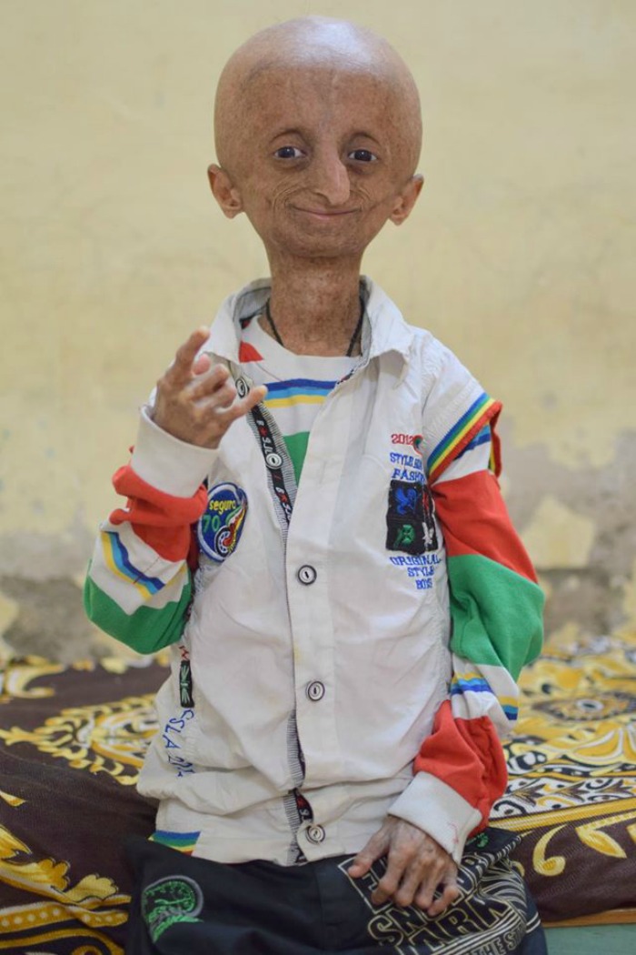 Nihal Bitla, Aamir Khan's Super Fan Who Suffered From Progeria, Passes ...