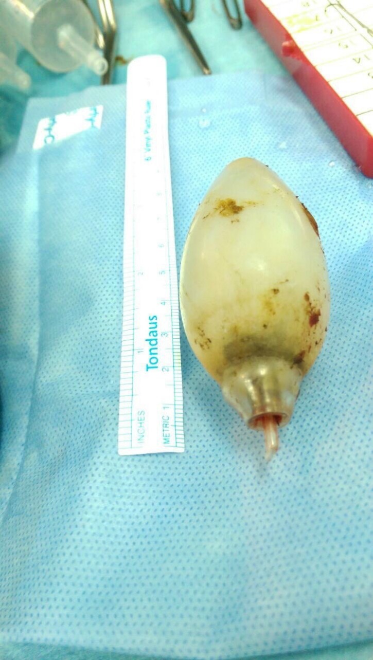 He Swallowed A Light Bulb As A Kid And Came To Regret It 11 Years Later