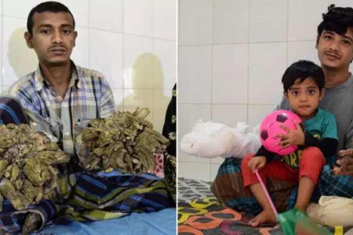 Meet 10 Yo Sahana Khatun The First Female To Be Diagnosed With Tree