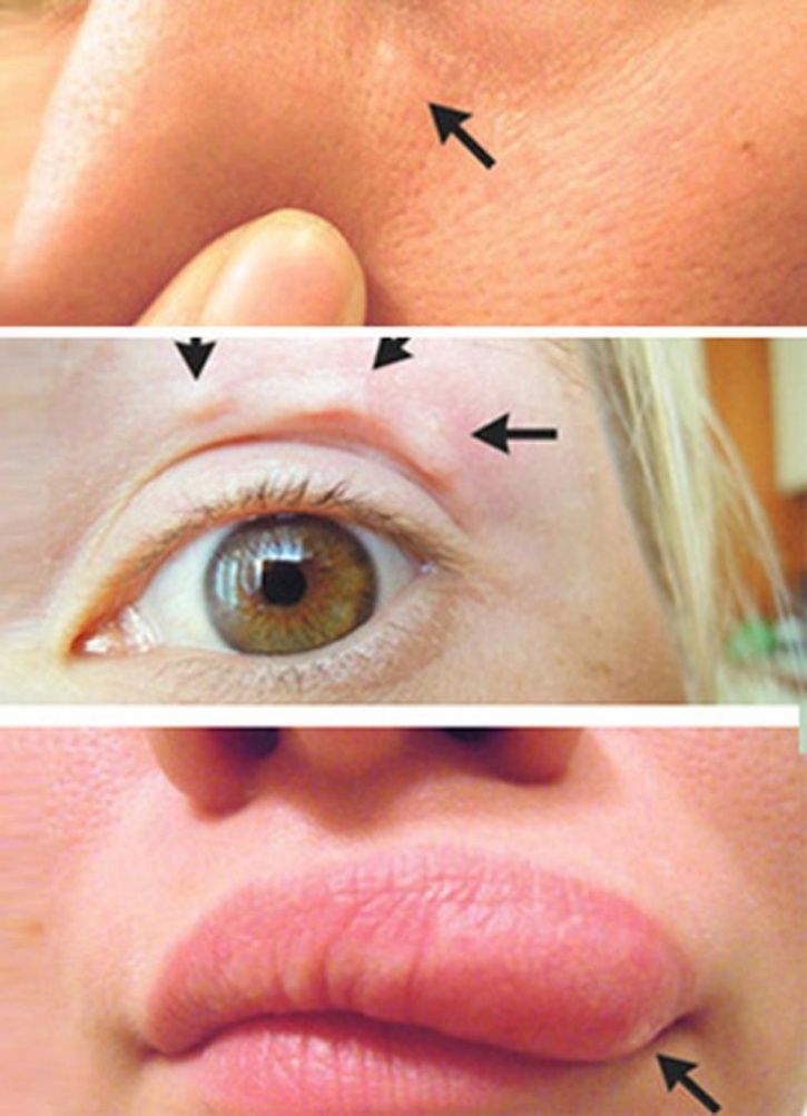 This Woman Discovered A Moving Bump Under Her Skin That Turned Out To ...