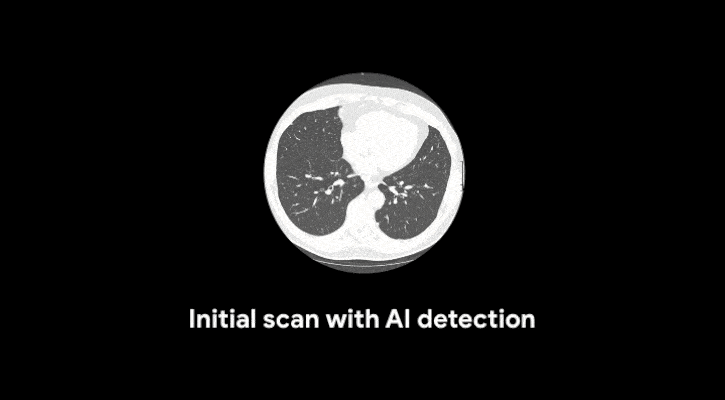 Google Developed An AI That Can Predict Lung Cancer Better Than Human ...