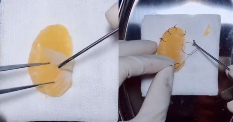 Doctor Practicing Kidney Surgery On An Orange Shows Difficulty Of Their Job