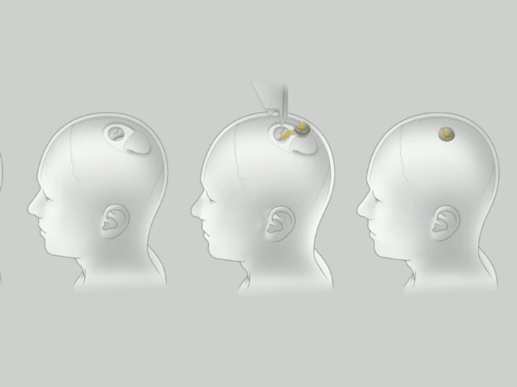 Elon Musk's Telepathic Brain Chip 'Neuralink' Could See First Human ...