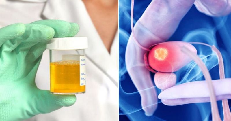 Urine Test Can Now Detect Bladder Cancer Ten Years Before Symptoms ...