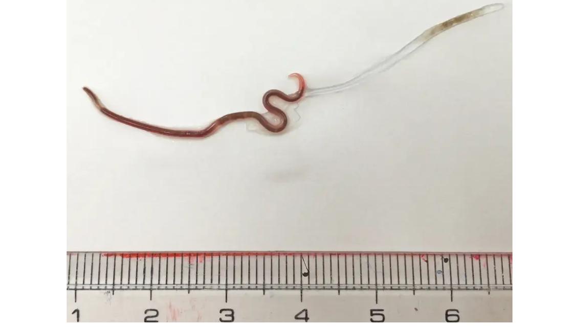 After Sore Throat Roundworm Found in Woman's Tonsil