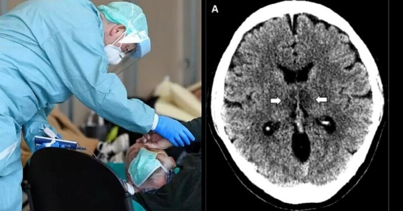 Study Claims, COVID-19 Could Cause Brain Damage, Strokes & Psychosis In ...
