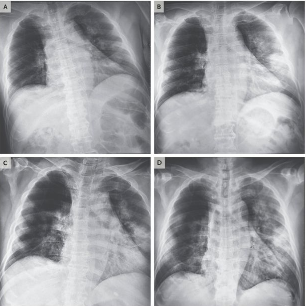Disturbing X-Ray Images Show The Dastardly Effects Of Coronavirus On ...