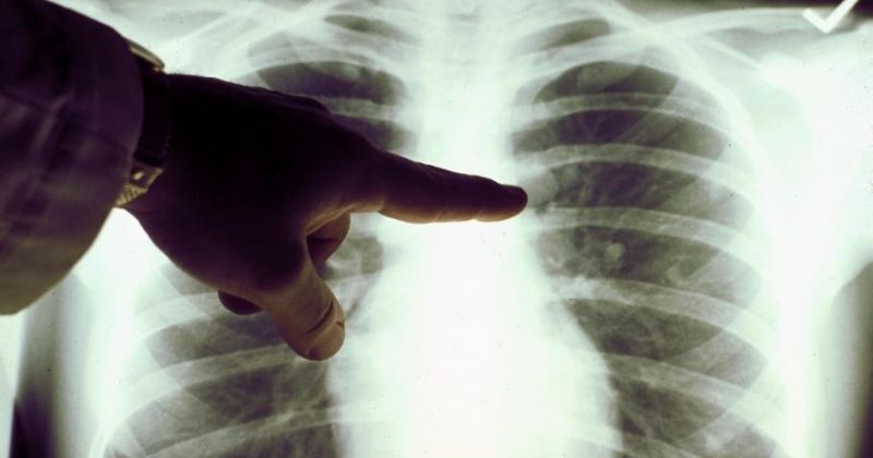 Scientists Develop Quick, Accurate Lung Cancer Detection From Blood ...