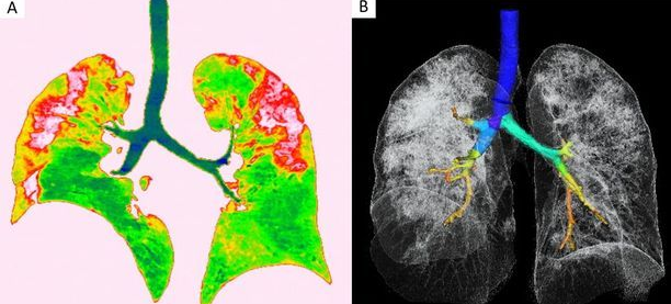 Disturbing X-Ray Images Show The Dastardly Effects Of Coronavirus On ...