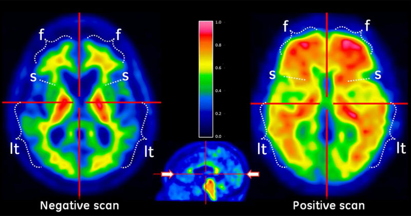 Psychedelic Drugs Like LSD 'Reset' The Brain, Help Patients With ... Psychedelic Drugs Like LSD 'Reset' The Brain, Help Patients With ...