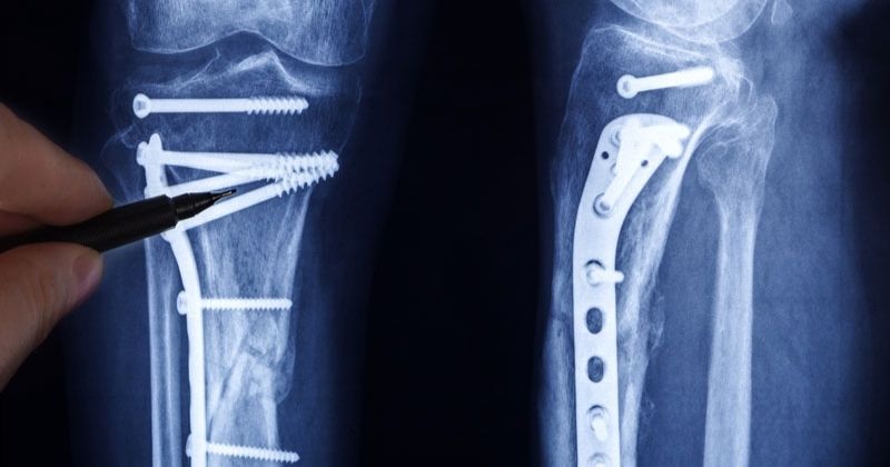 IIT Madras Researchers Build Magnesium Alloys For Healing Bones Better ...