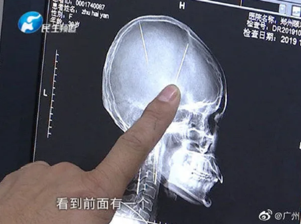 Chinese Woman Finds Two Needles Embedded In Her Brain