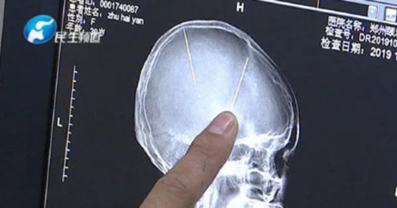 Chinese Woman Finds Two Needles Embedded In Her Brain
