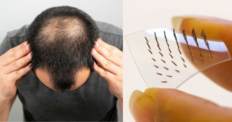 Scientists Find Cure For Male Baldness Using A Micro-Needle Patch