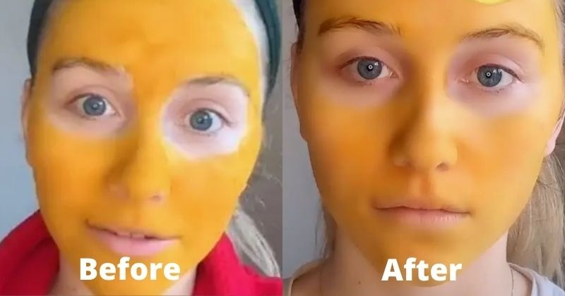 Woman's Face Turns Yellow After Using DIY Turmeric Facemask