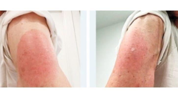 Moderna COVID Vaccine Is Causing Skin Rashes In Few Cases, But Don't Worry