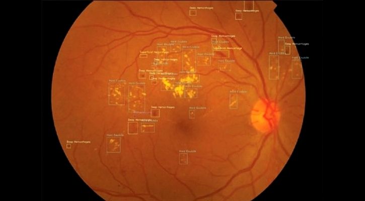 Intel AI Detects Diabetic Retinopathy In Minutes That Saves People’s ...