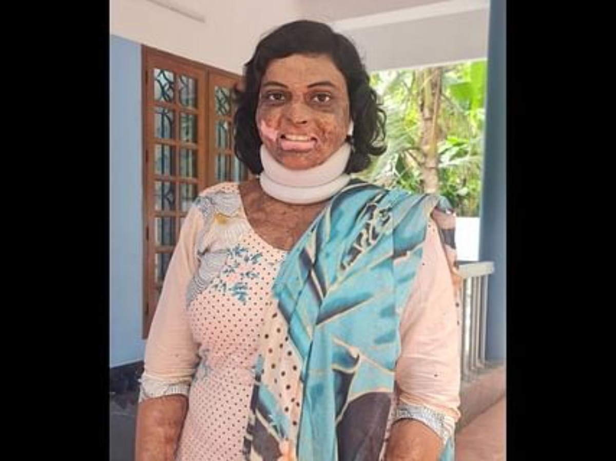 This Burn Survivor Is Helping Others Like Her With Free Reconstructive ...