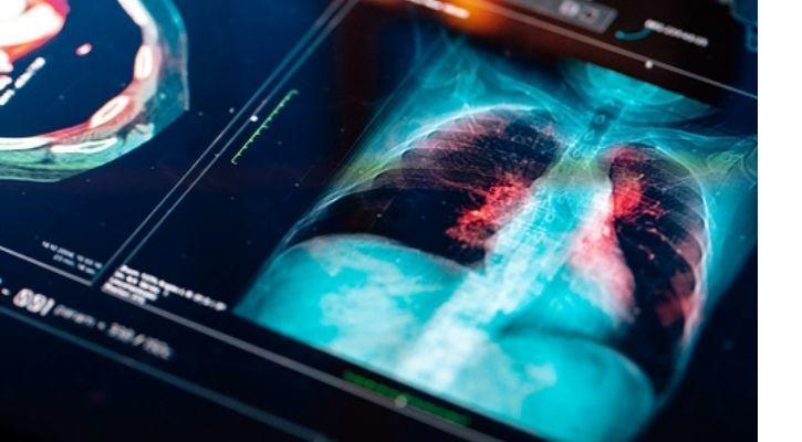 Microplastics Found Deep Inside The Lungs Of Living People For The ...