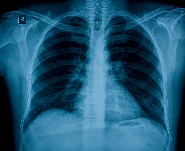 Ai That Scans X Rays For Abnormalities Without Humans Approved For Use