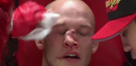 MMA Fighter Blake Perry Suffers Horrific Broken Nose