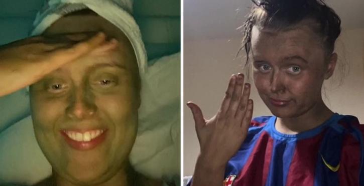 Woman Fell Asleep In Sun Wakes Up With 'Plastic' Forehead