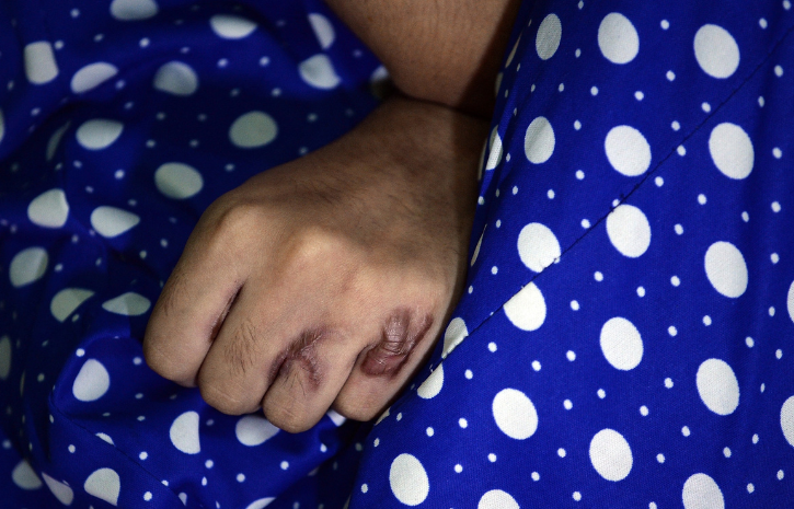 How Do Acid Attacks Remain A Severe Concern In India?