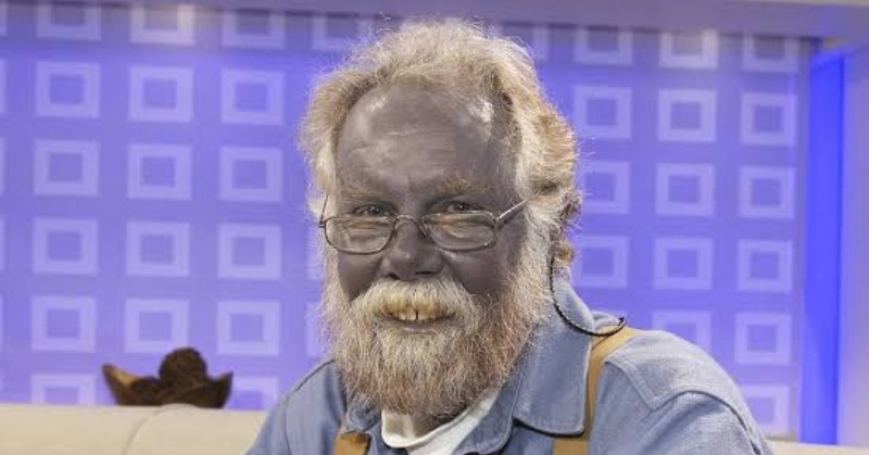American Man Turned Blue After Taking Supplements