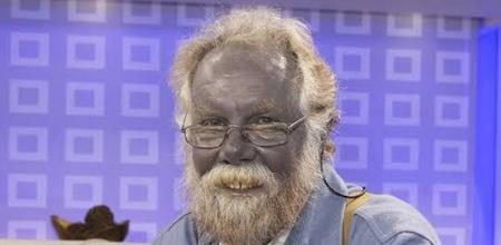 American Man Turned Blue After Taking Supplements