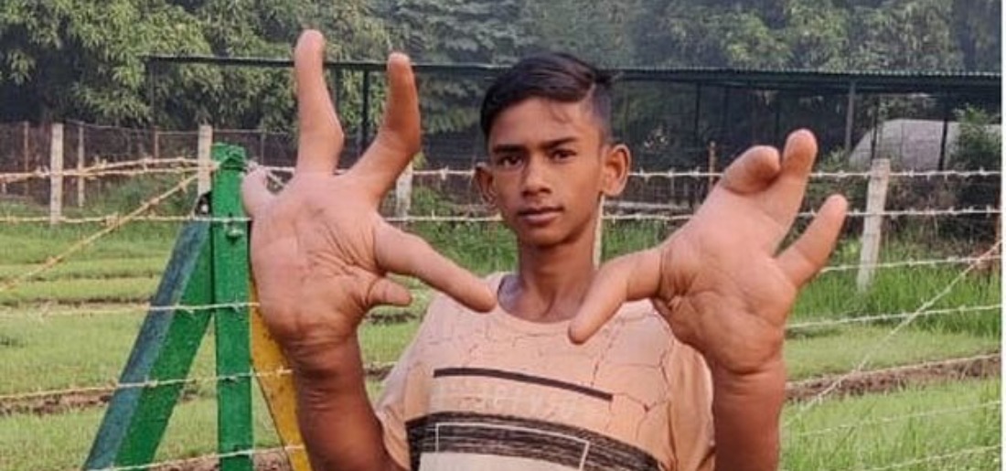 Jharkhand Boy Develops 2ft-Long 'Hulk Hands'