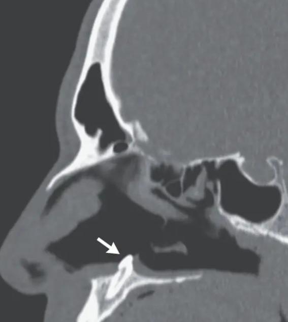Man Had Tooth Growing Inside Nose