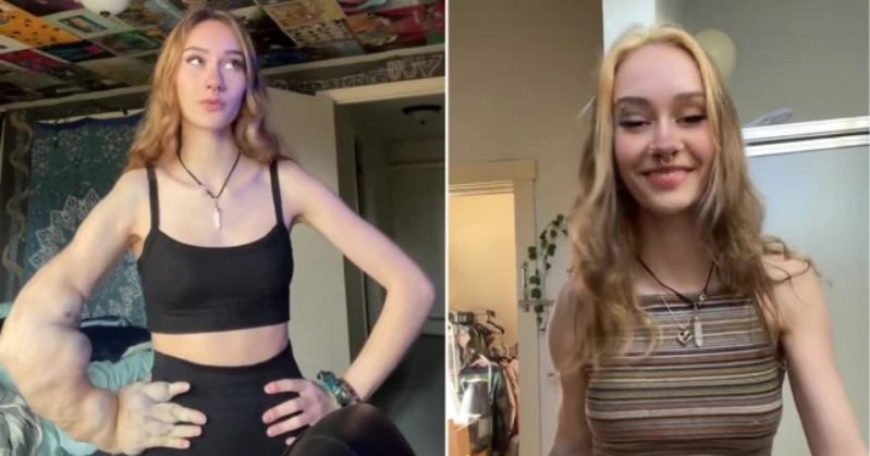 Woman Born With Huge Arms Says Strangers Ask Her To Amputate It