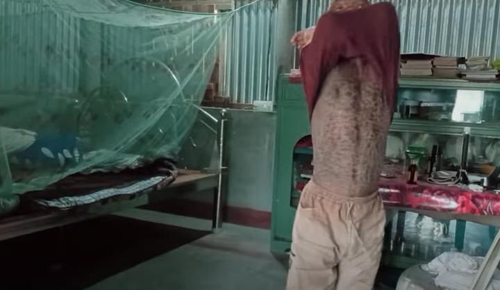 Man's Skin Sheds Every Week In Rare Condition Called Erythroderma