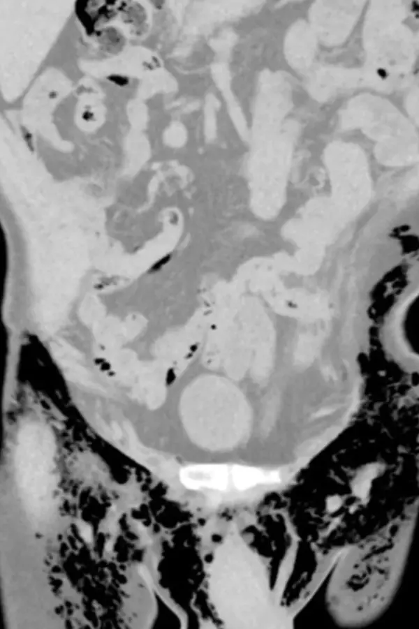 Man Left With Whistling Scrotum After Bad Surgery