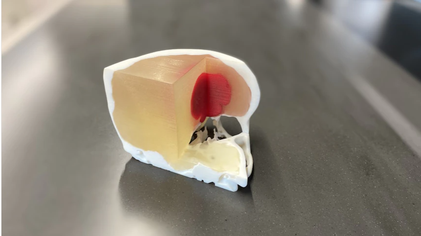 Revolutionary 3D-Printed Body Parts Are Helping Cancer Patients In ...