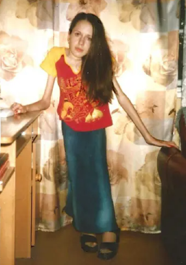 Woman With Rare Medical Condition Can't Sit