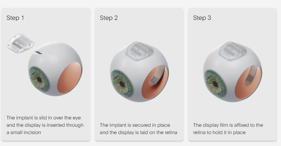 Neuralink Co-Founder's New Rival Company Requires No Hole-Drilling In ...