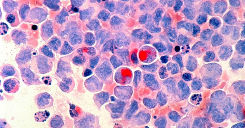 Switching To A Low-Protein Diet Makes Cancer Cells Starve, Betters ...