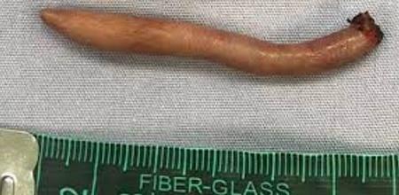 Baby Girl Born With Tail Gets The Body Part Removed