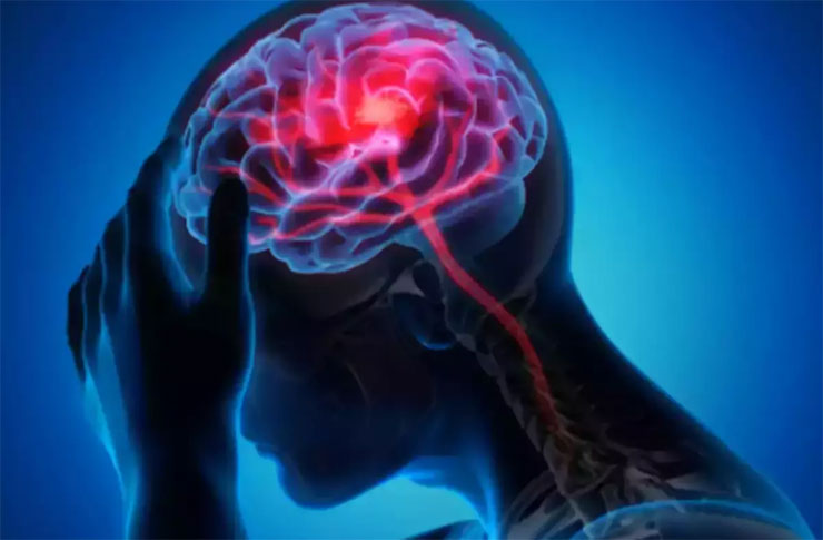 Explained: Ischemic Stroke In Young Adults; Signs And Recovery
