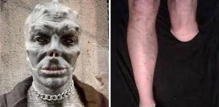 'Black Alien' Shares Picture Of 'Leg Chopped Off'