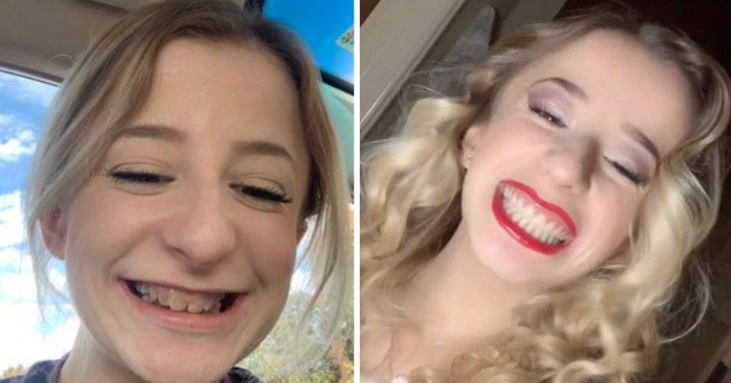 Woman Born With 'Transparent' Teeth Gets Life-changing Dental Surgery