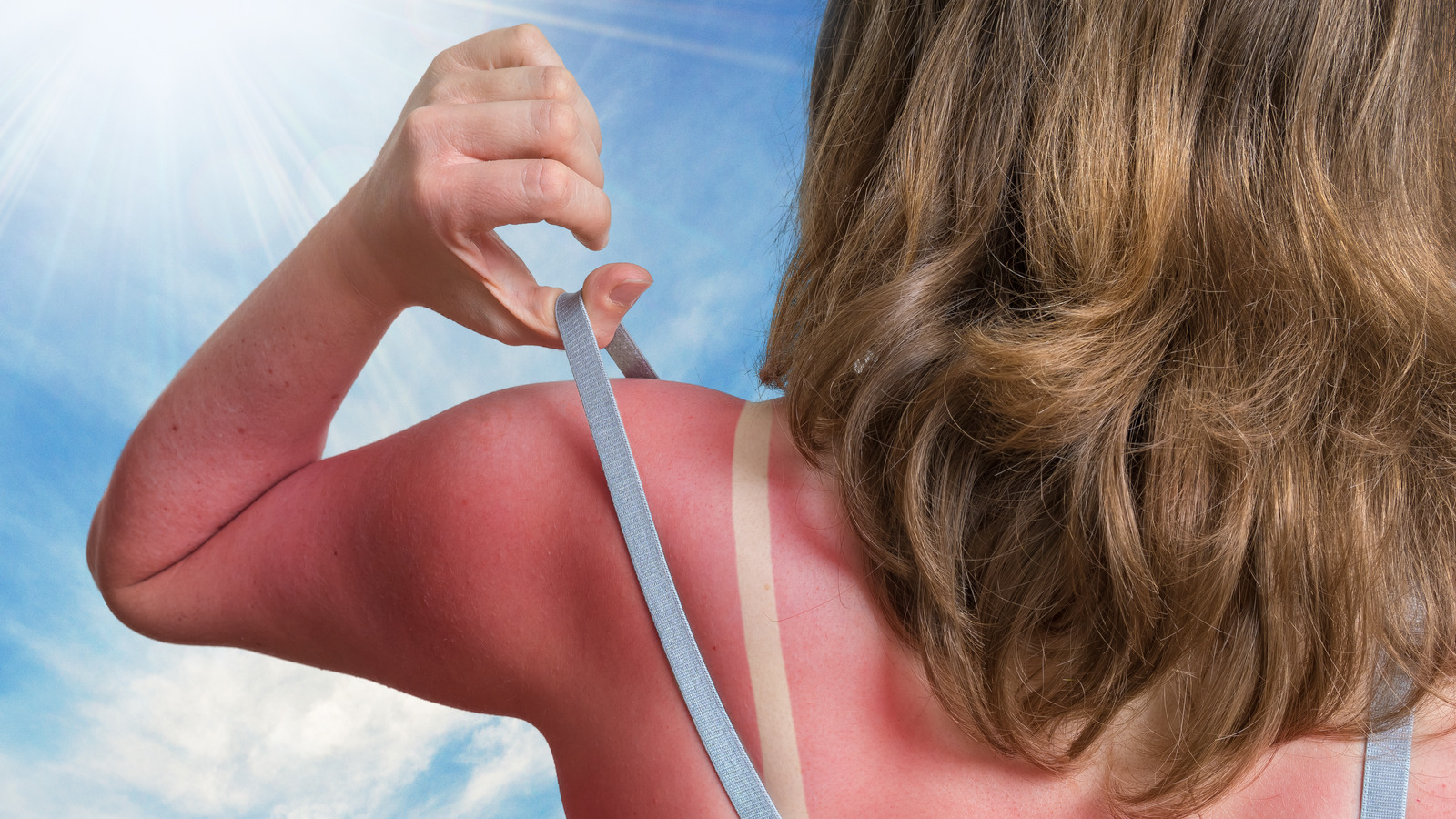 Summer Care: Understand The Difference Between Sun Poisoning And Heatstroke
