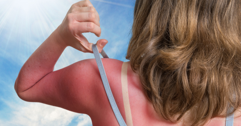 Summer Care: Understand The Difference Between Sun Poisoning And Heatstroke