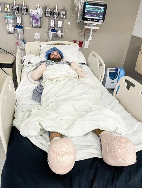 US Man Loses Both His Hands, Feet From A Single Flea Bite: Here's How ...