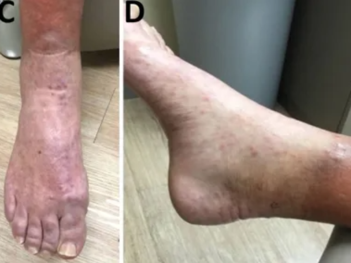 Leprosy Could Become Endemic In Florida: Here's What We Know