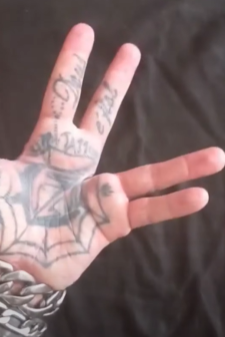 Marcelo “B-boy” De Souza Ribeiro Gets Surgery To Split His Hand In Two