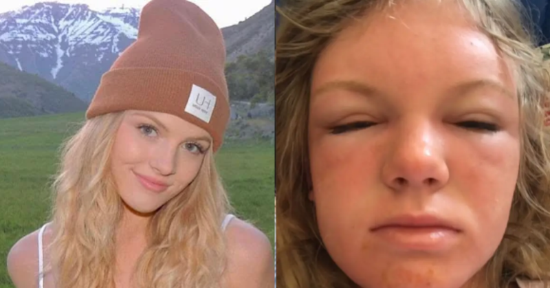 Woman's Sunburn Causes Severe Facial Swelling