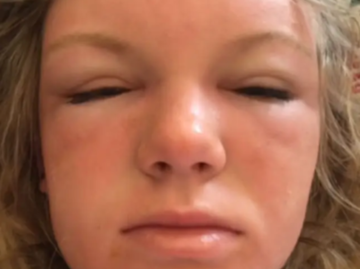 Woman's Sunburn Causes Severe Facial Swelling